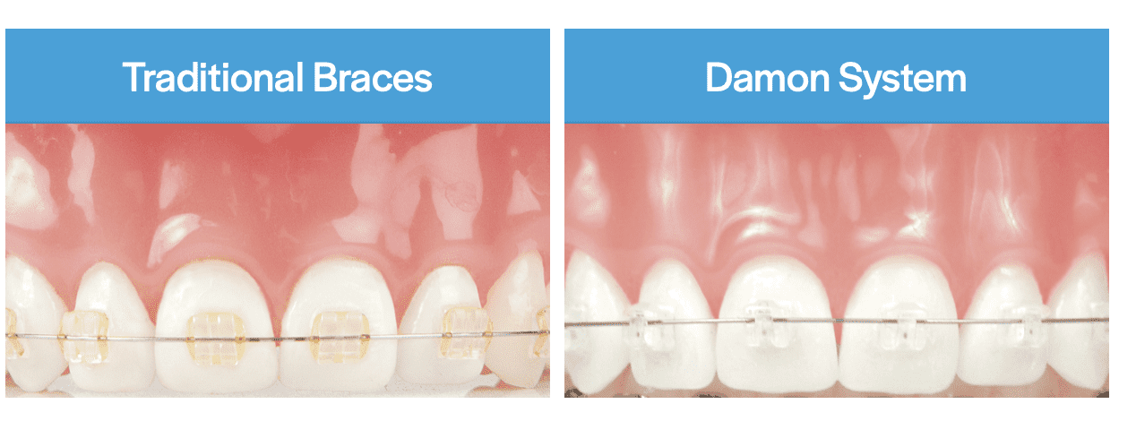 Orthodontics: The Difference Between Invisalign and Damon Braces ...